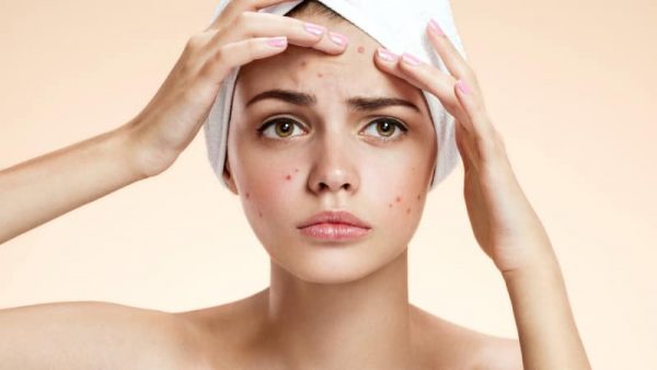 Penyebab dan Cara Mengatasi Jerawat Pustula | Infopena.com